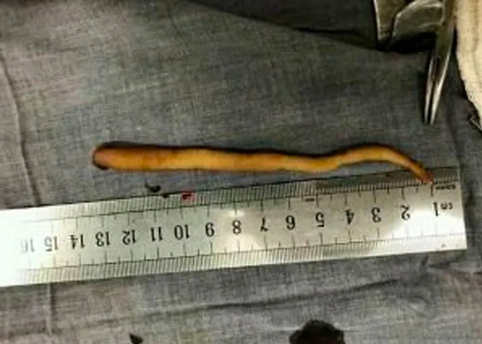 Una bebé nace en Colombia con cola vestigial