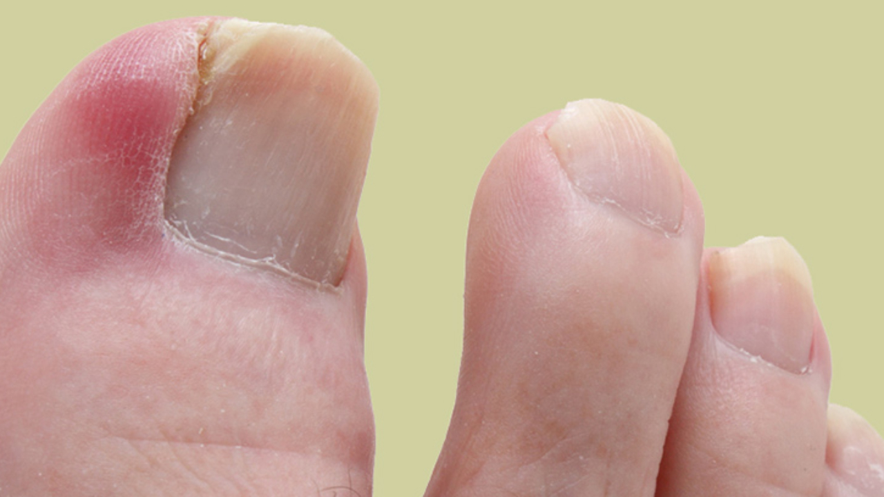 Cómo solucionar unas uñas encarnadas