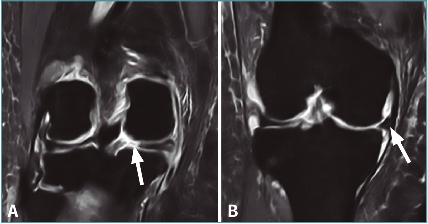 Qué es el menisco, dónde se ubica y cómo se lesiona