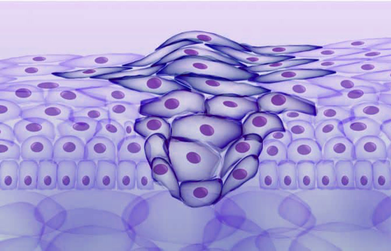 Qué es la neoplasia - 24 diciembre, 2020 06:13