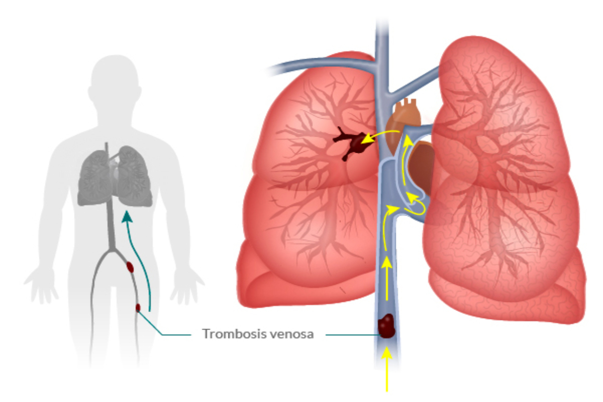 Qué es una embolia pulmonar 30 diciembre, 2020 Qué es una embolia pulmonar 30 diciembre, 2020