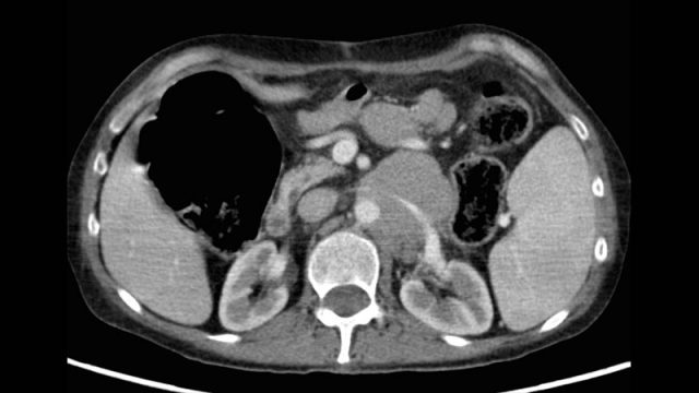 Qué es un TAC con contraste