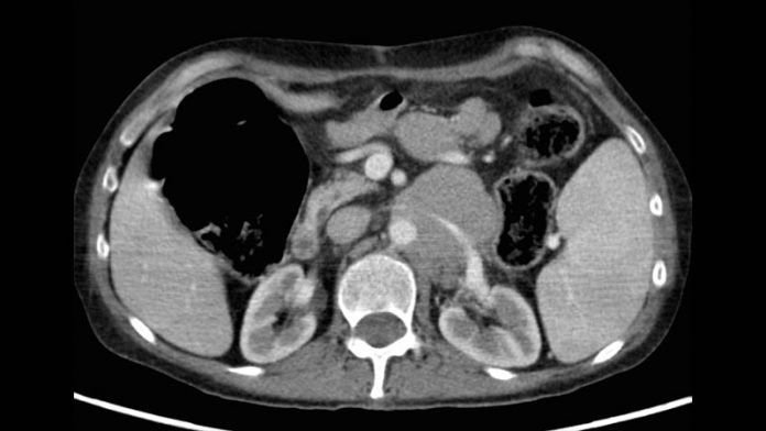 Qué es un TAC con contraste