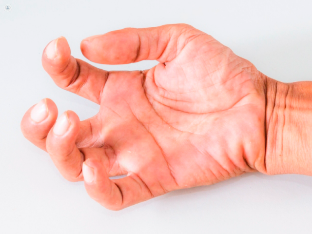 Qué es la espasticidad