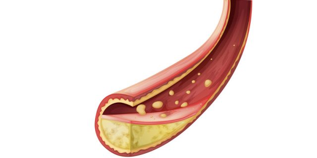 Qué es una angina de pecho