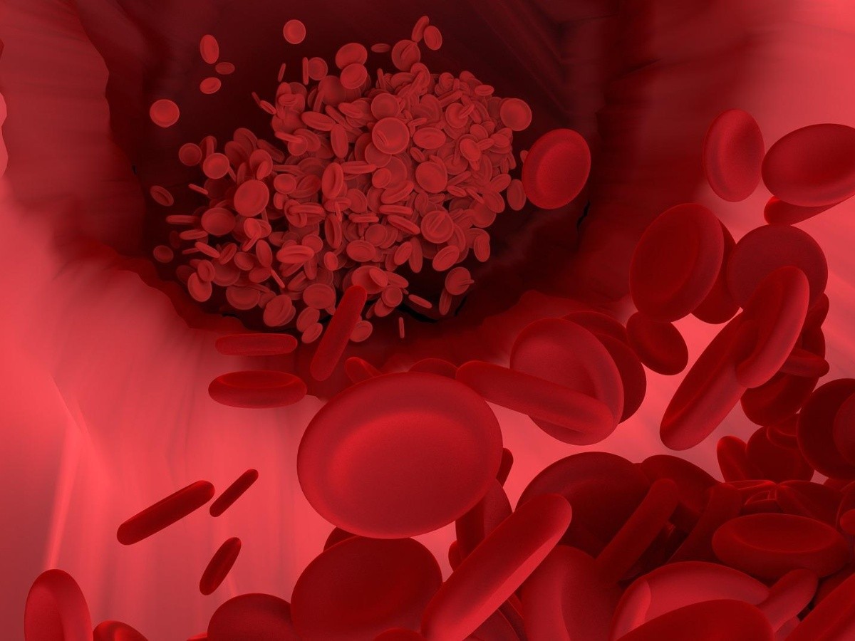 Qué es el tromboembolismo