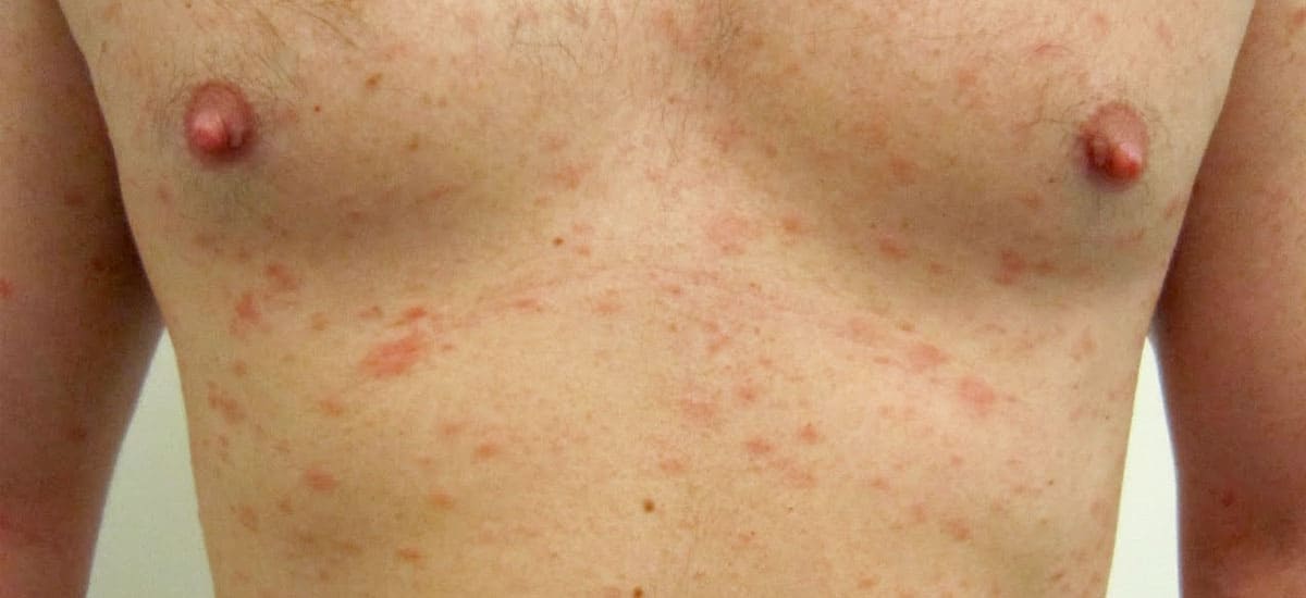 Qué es la pitiriasis rosada