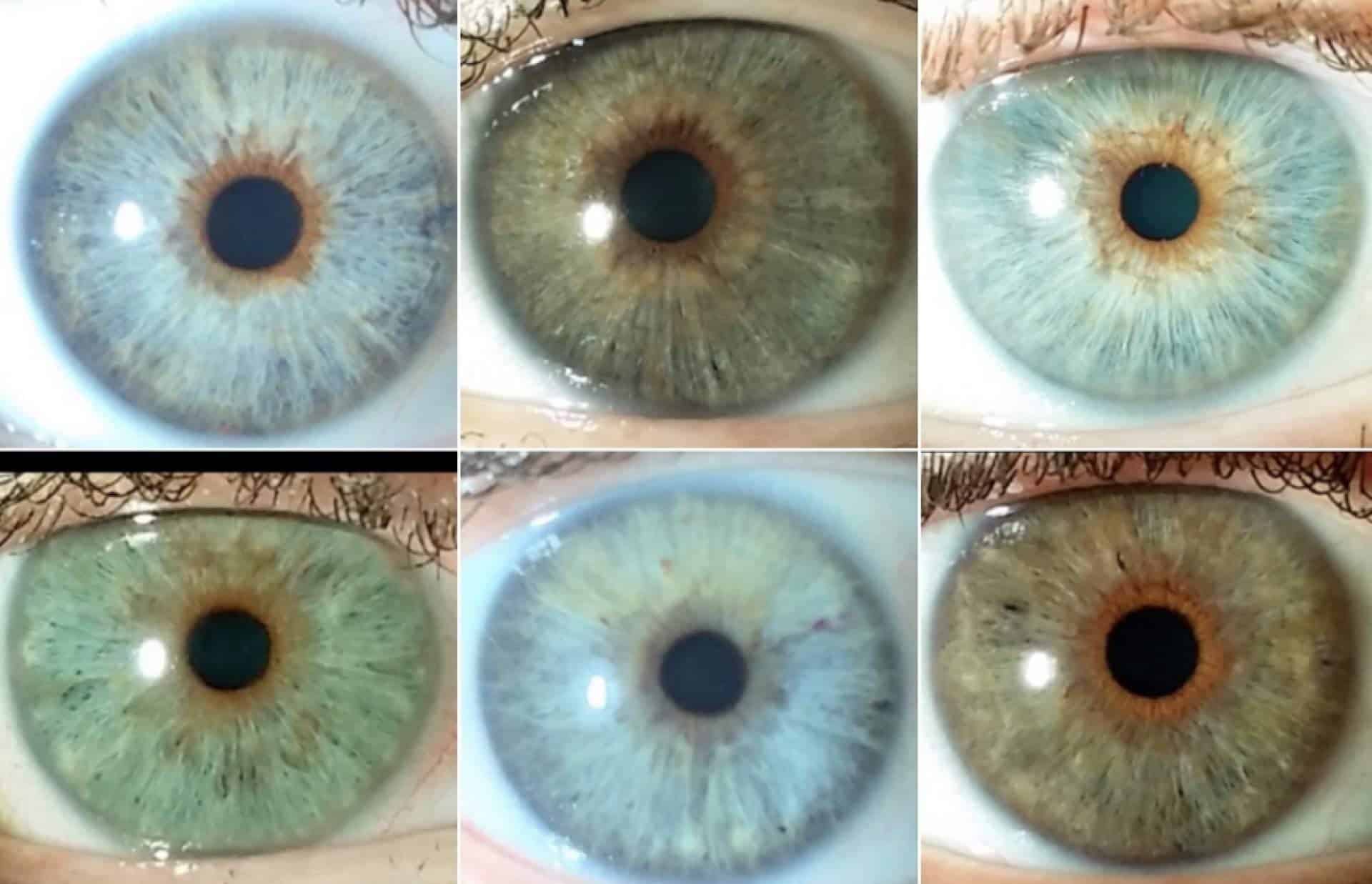 El método de Clínica Eyecos para modificar el color de los ojos de ...
