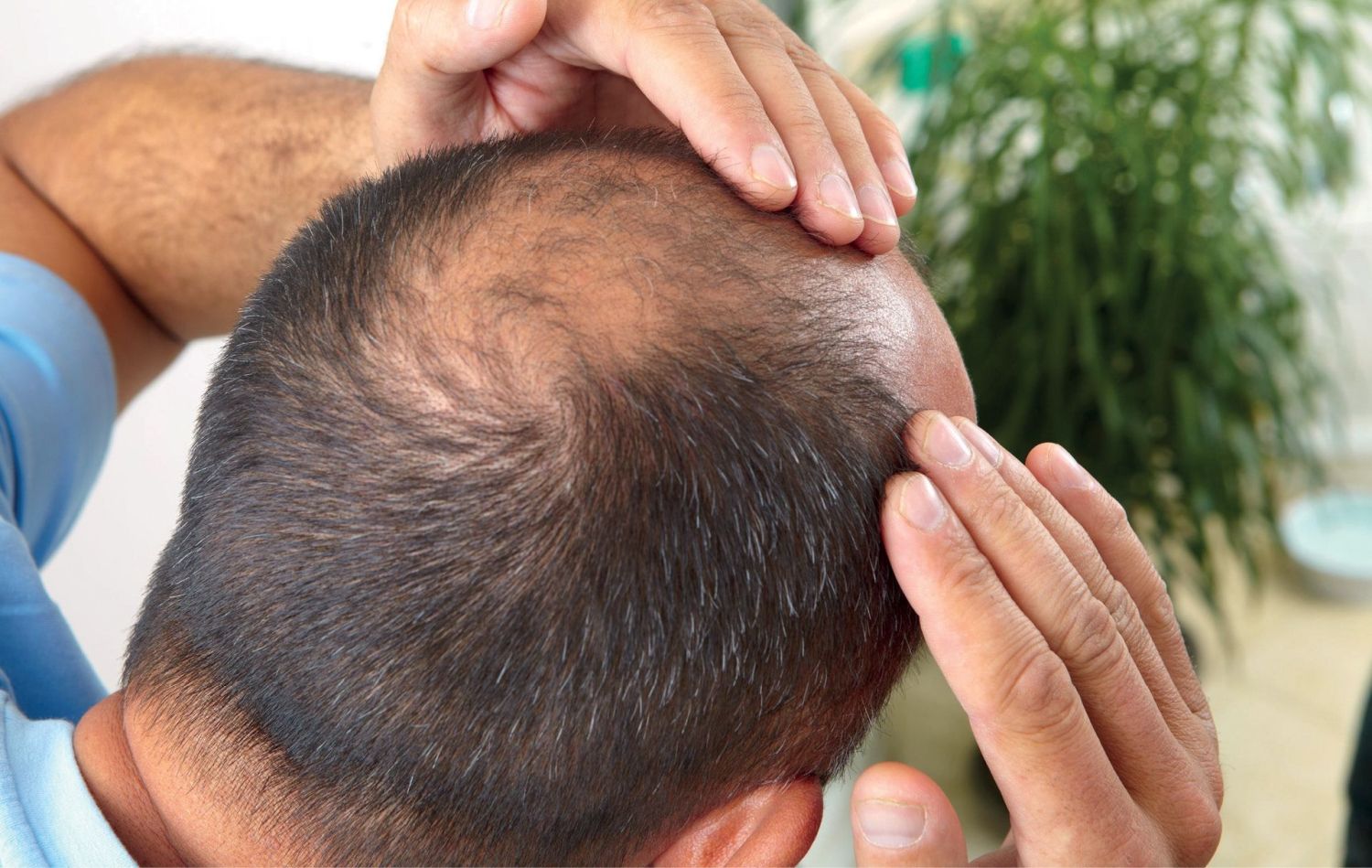 6 remedios caseros para combatir la caída del cabello