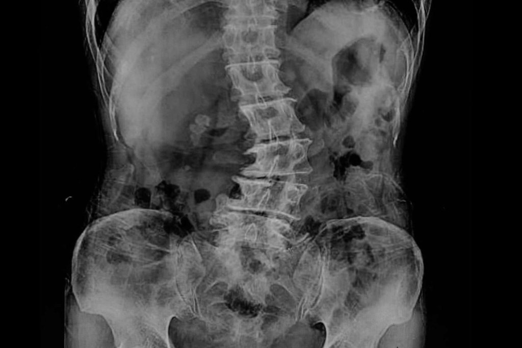 Cuáles son las principales causas y tratamientos de la escoliosis lumbar