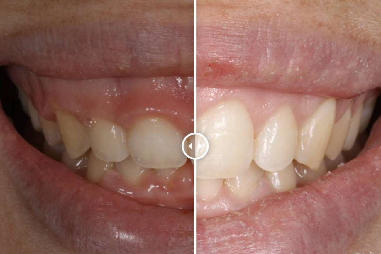 ¿cómo Corregir La Sonrisa Gingival Por Clínica Dental Ruiz De Gopegui