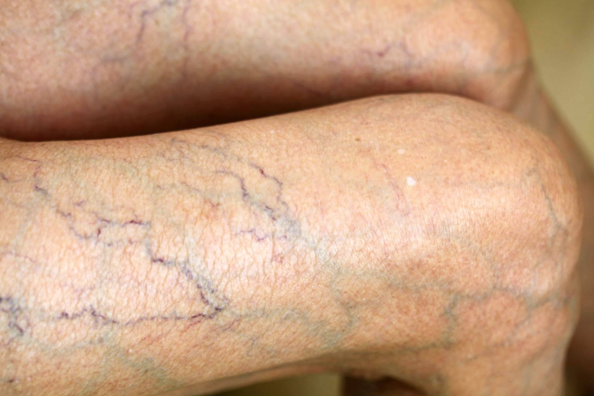 El tratamiento para la insuficiencia venosa crónica de iXalud