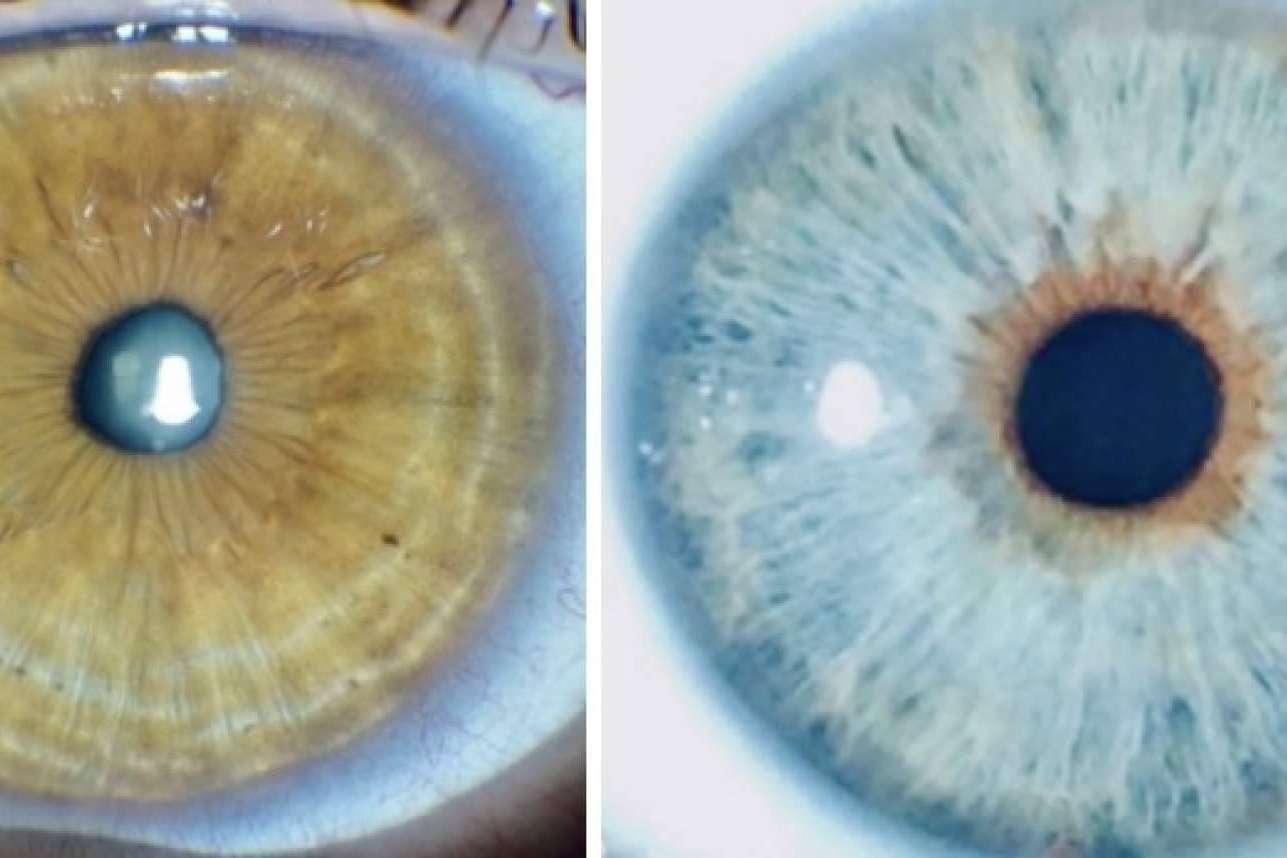 Eyecos, la clínica que puede predecir y simular en 3D el resultado del ...